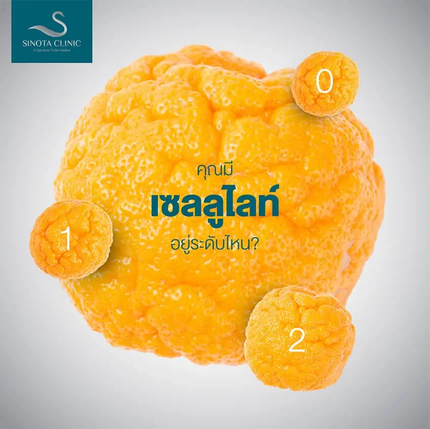 ลุ้นทำ Thermo Beam ฟรี! กำจัดเซลลูไลท์แบบออกแบบสวยๆ ไม่ต้องเสียเงิน