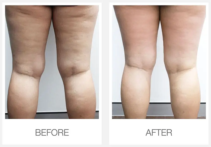 กิจกรรม Kill Cellulite กำจัดเซลลูไลท์ สลายไขมันด้วย Thermo Beam