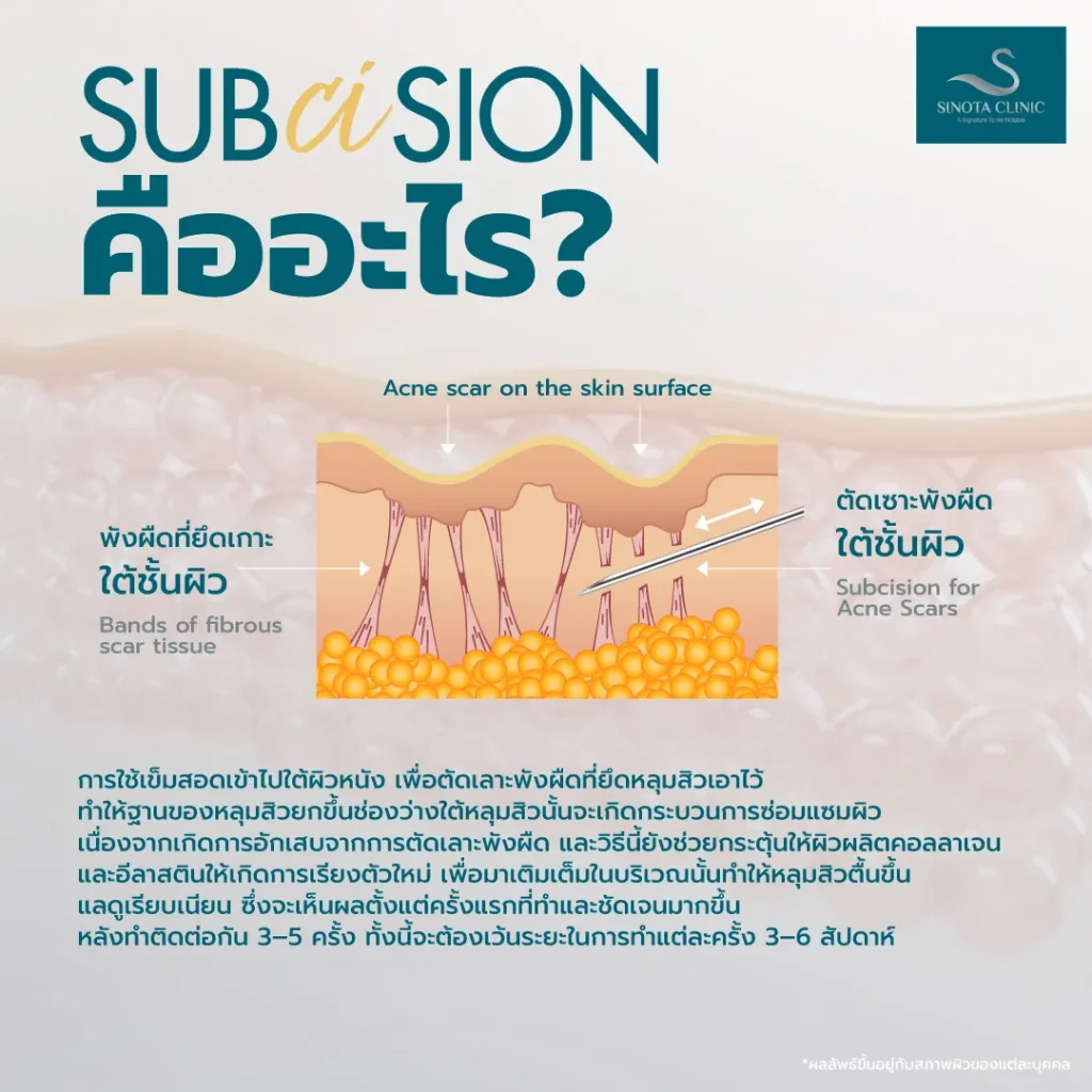หลุมสิวรักษาได้ด้วย Subcision หลุมสิวจริงไหม - Sinota Clinic